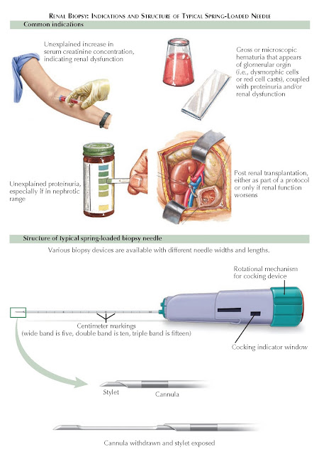 RENAL BIOPSY - pediagenosis