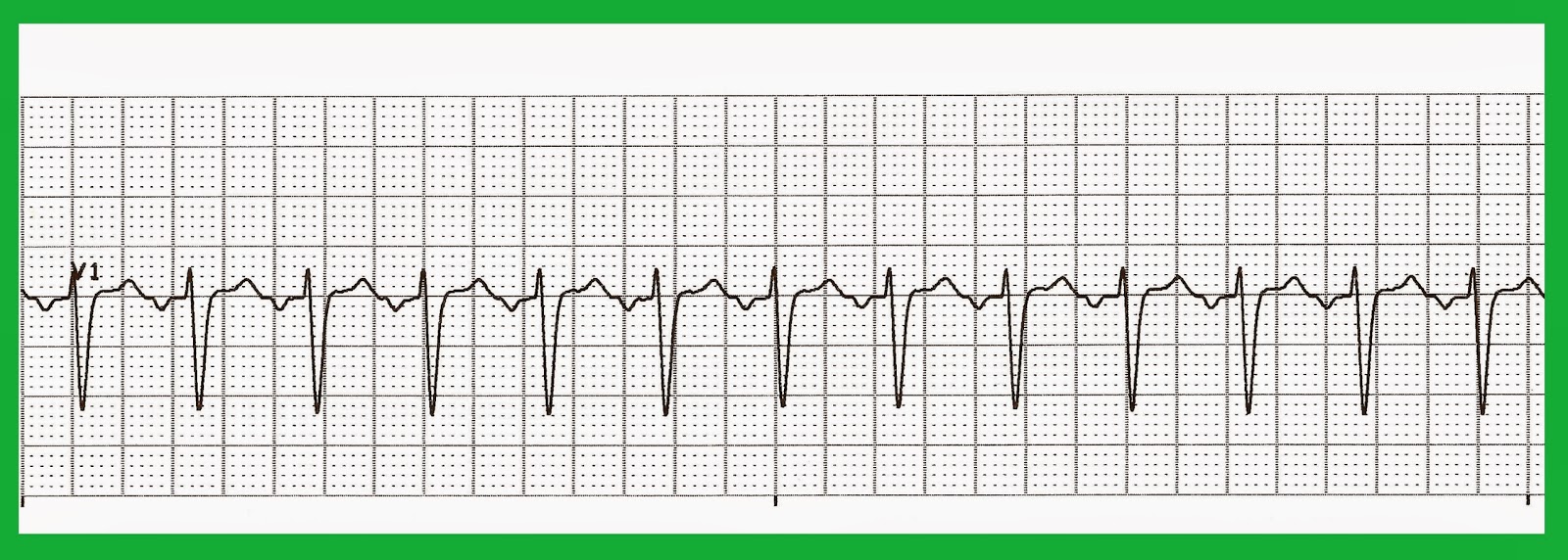 Practice Rhythm Strips 290