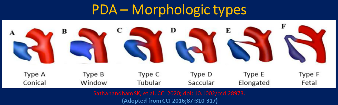Pedi cardiology: PDA Morphologic Types - Updated 2016