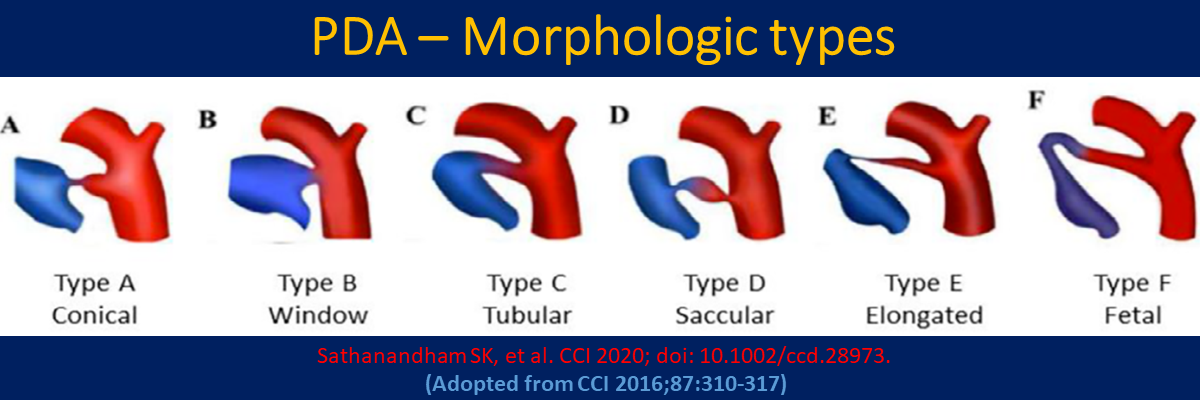 Pedi Cardiology Pda Morphologic Types Updated 2016