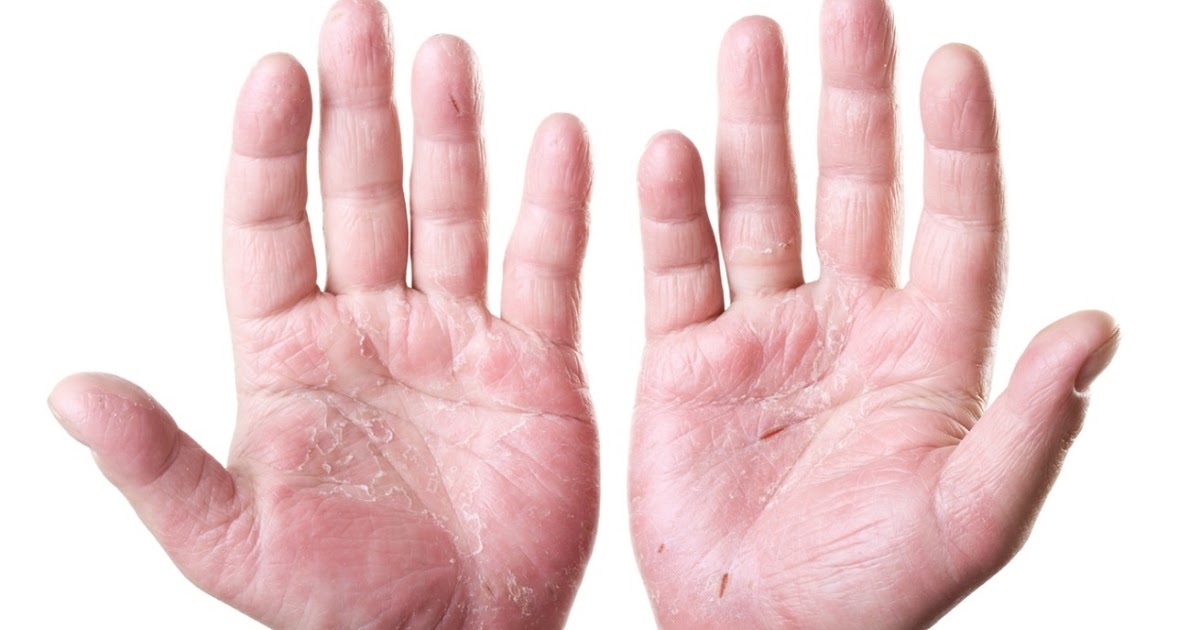 Your Skin for Life: Common Rashes of the Skin :Part 1- Hand Dermatitis
