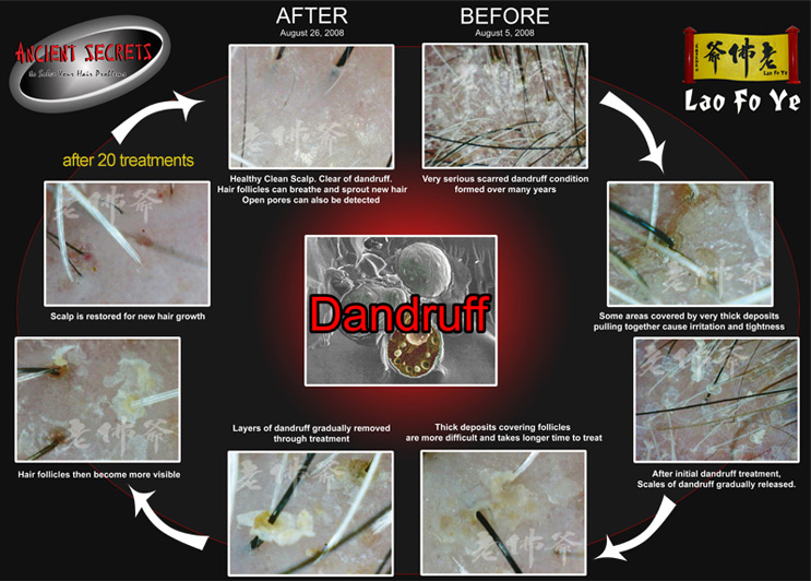 Lao Fo Ye Hair Care Centre: Dandruff Problem