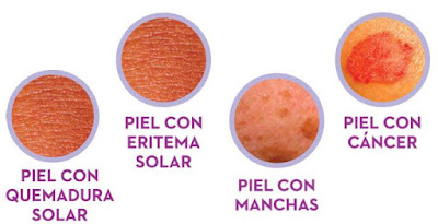 Neozen Estética: Quemaduras solares, qué hacer y cómo prevenirlas