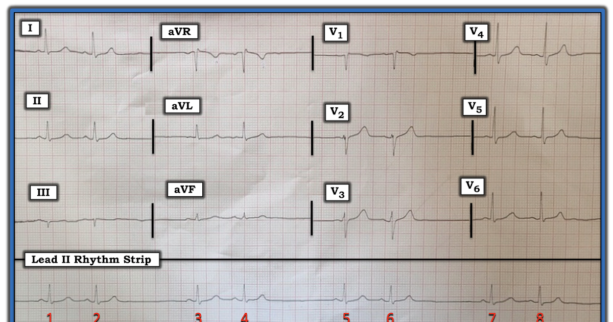 ECG Interpretation: ECG Blog #252 (66) — Mobitz I? Mobitz II? or Not?