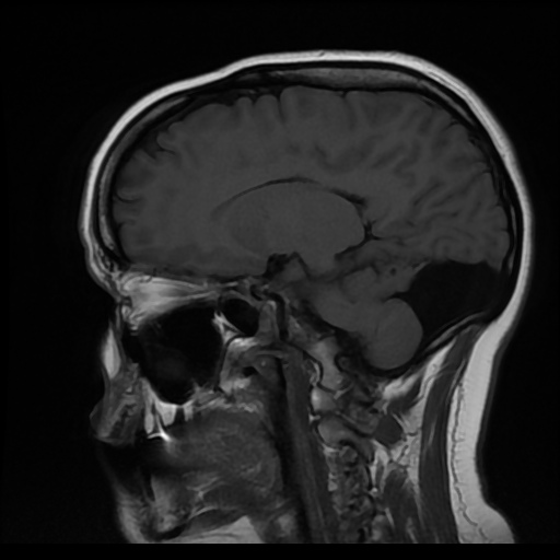 Beyond Passing Time: Understanding and managing the symptoms of Dandy ...