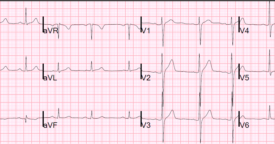 Dr. Smith's ECG Blog: Inferior Dynamic T-waves