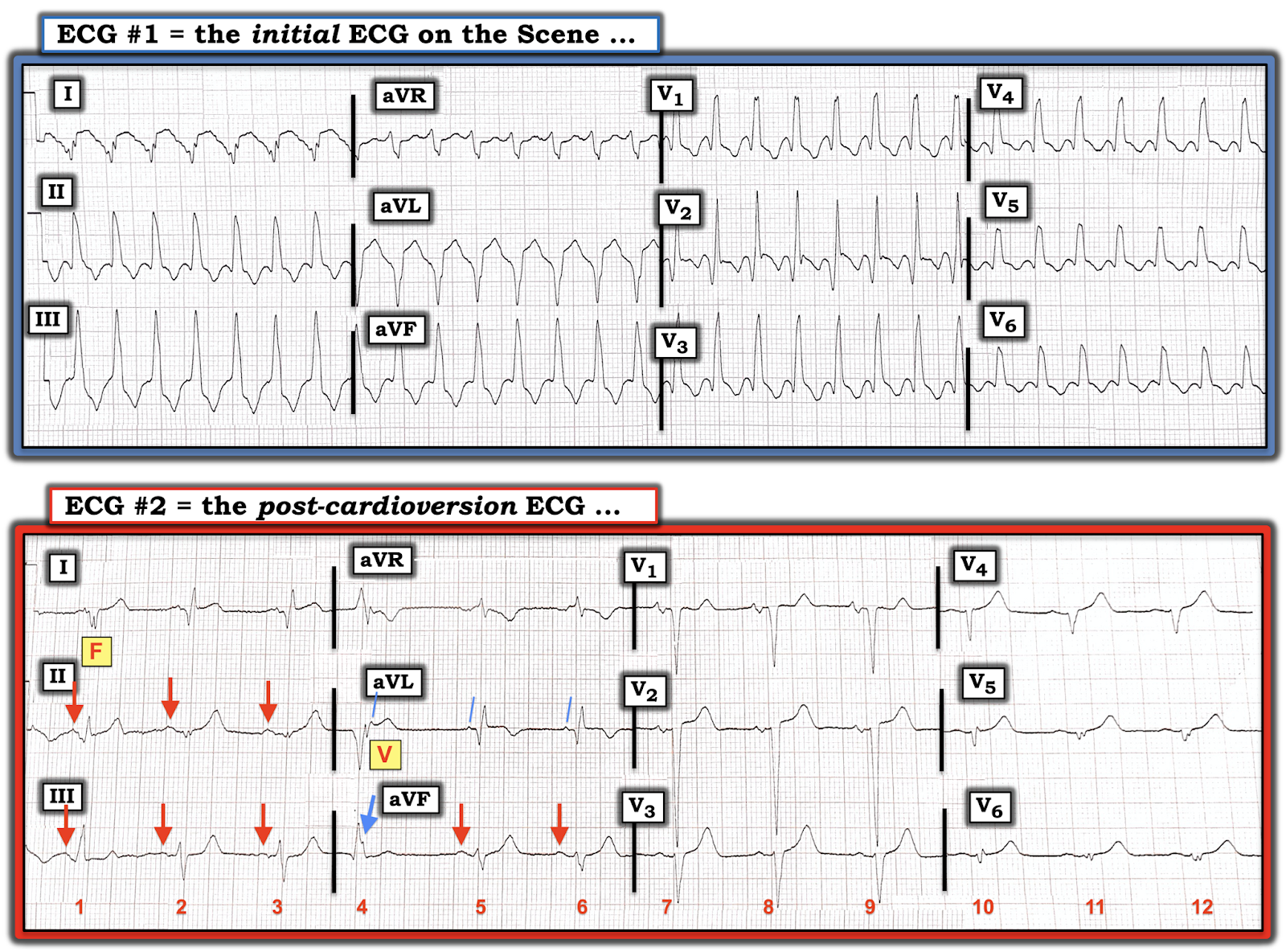 Dr. Smith's ECG Blog: Is it VT or SVT with Aberrancy?