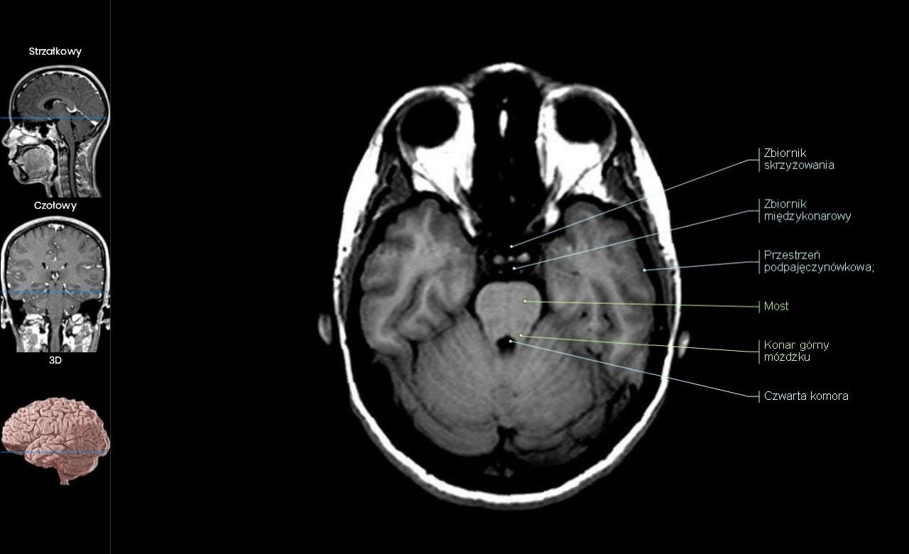 RM głowy - anatomia mózgowia (MRI) T1-axial