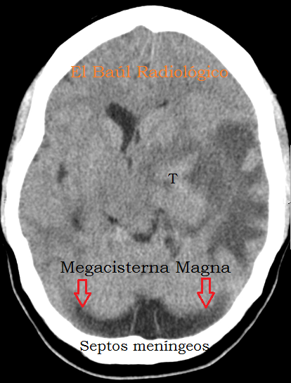 El Baúl Radiológico: ASPECTO DE LA CISTERNA MAGNA EN TOMOGRAFÍA ...