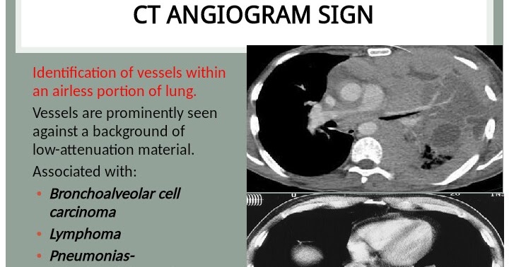 Chest Medicine Made Easy-Dr Deepu: CT angiogram sign