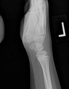 Os Radiale Externum -Plain film - Radiology Imaging