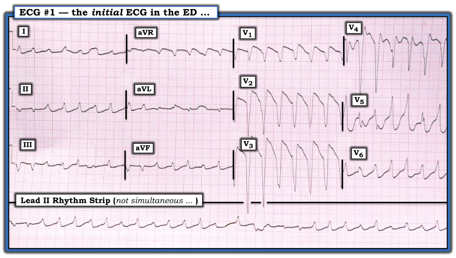 Example ecg tracing of ivcd - antiquegross