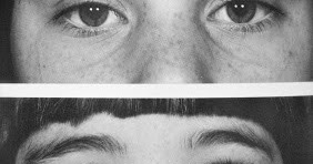 Síndrome de Möbius