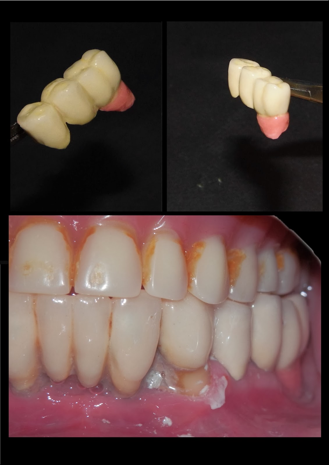 laboratoriodeserafinsalido: CORONAS METAL-PORCELANA