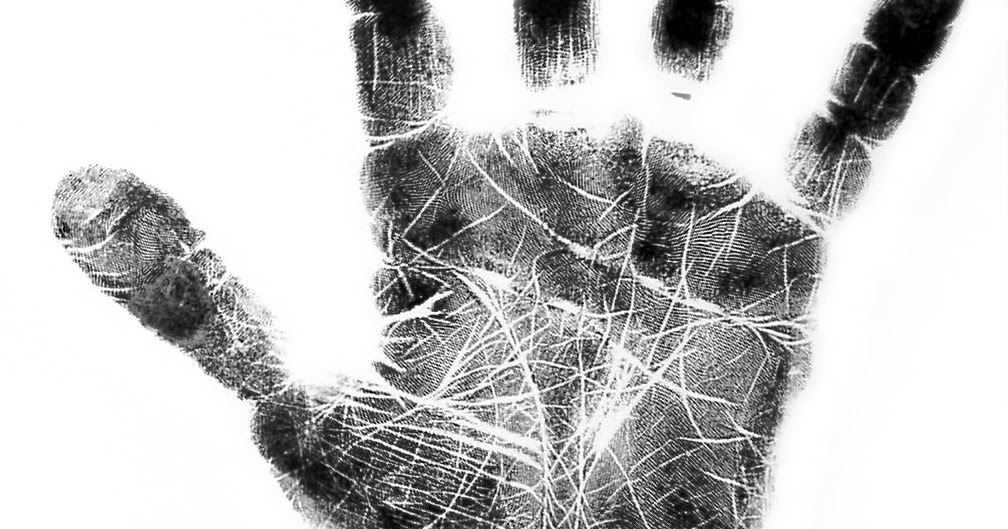 A burning handprint from hell -A lifelong reminder