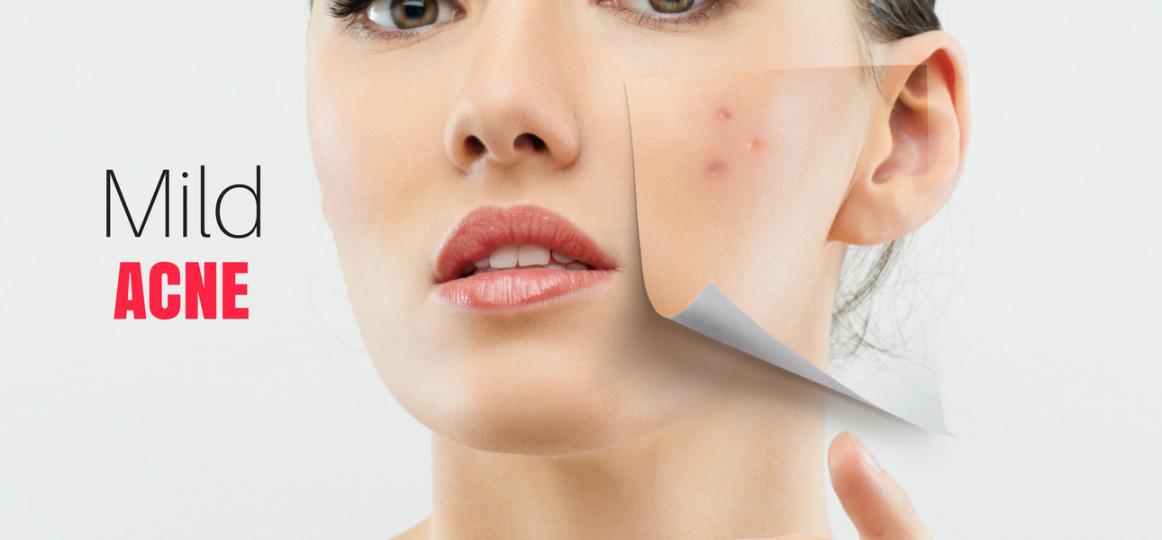 How to Deal with Different Type of Acne? - Skin Care Blog - Clinica ...