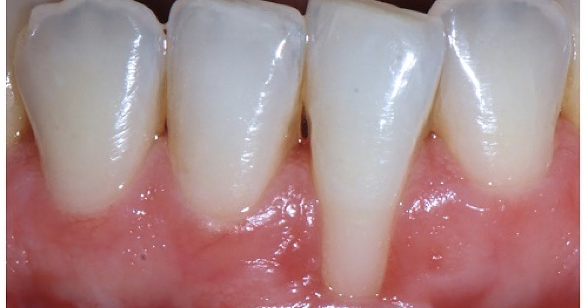 Studio Dentistico Balestro: Recessione gengivale