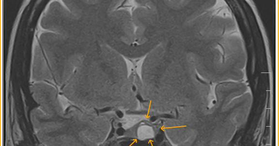 Rathke's Cleft Cyst :MRI - Radiology Imaging