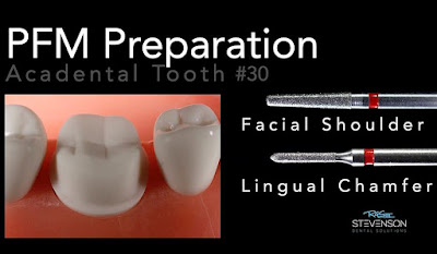 PROSTHODONTICS: PFM Preparation #30 step by step - Acadental