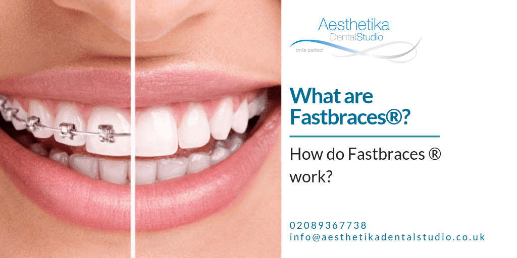 What Are Fastbraces?