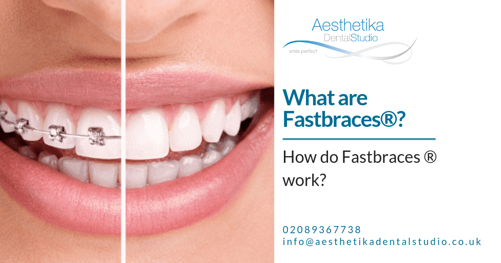 What Are Fastbraces?