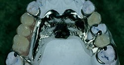 Conectores mayores en protesis parcial removible
