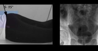 Sacro Coccix- PA Axial