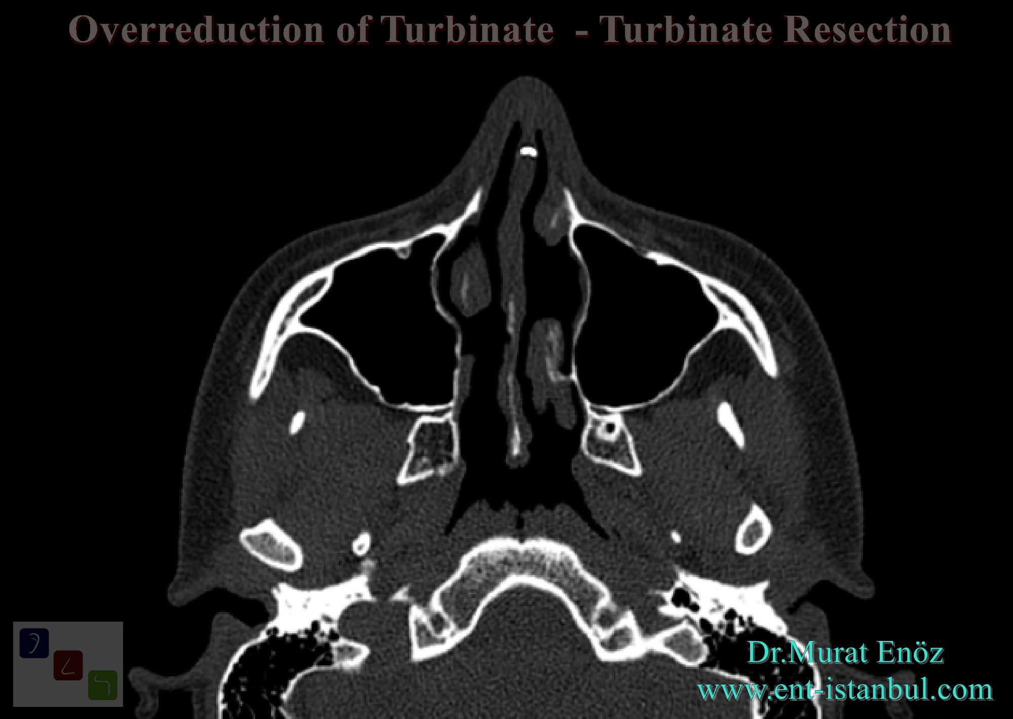 Overreduction of Turbinate - Nasal Hyperventilation