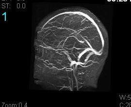 Basal Vein of Rosenthal Thrombosis-MRV - Sumer's Radiology Blog
