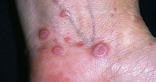 Lichen planus VS lichenoid reactions