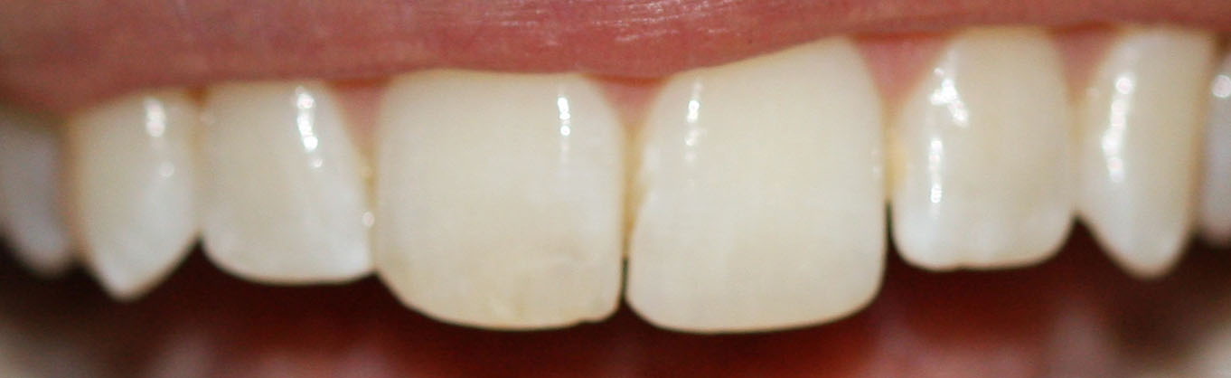 James R. Waters, DDS, MSD, PA: Re-shaping and polishing edges of teeth ...