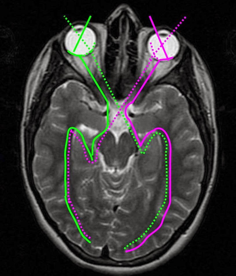 Diarios de Radiologia: TRACTOGRAFÍA: EL CEREBRO AL DESCUBIERTO