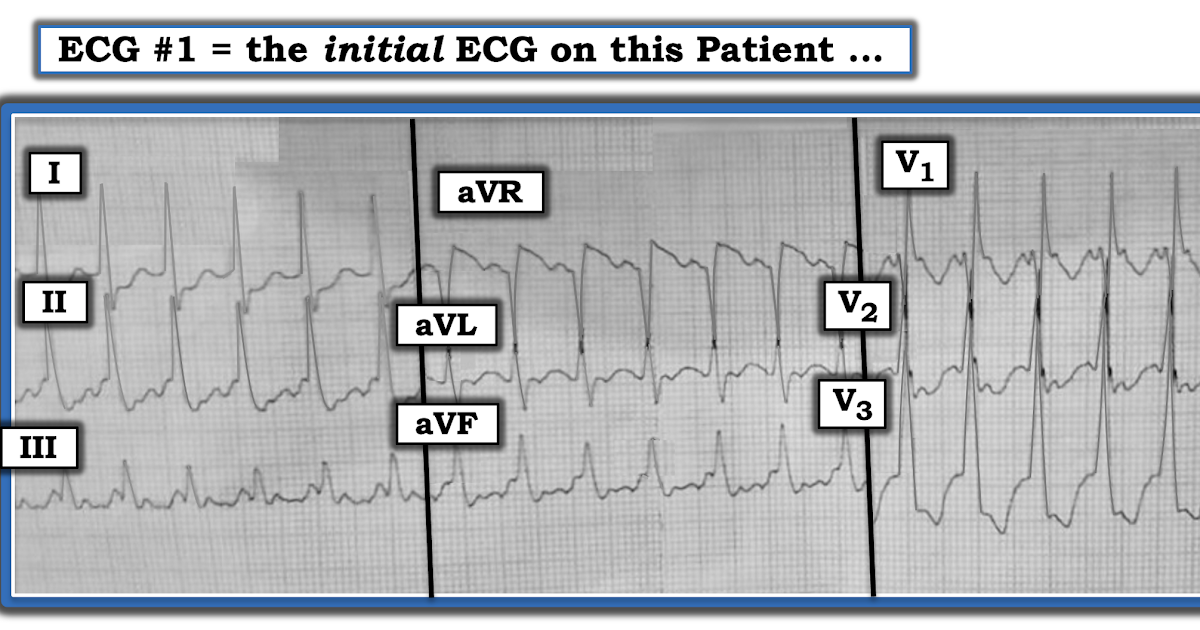 ECG Interpretation: ECG Blog #229 — VT or Something Else?