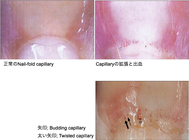 Hospitalist ~なんでも無い科医の勉強ノート~: Nail-fold capillary: 爪床毛細血管