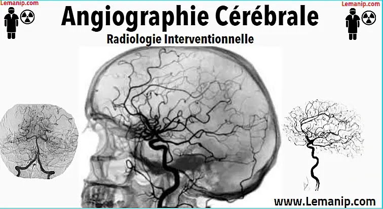 Angiographie Cérébrale