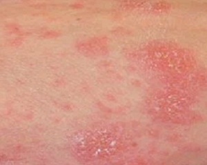 7 Penyebab Gatal Pada Kulit, beserta Tanda-Tandanya