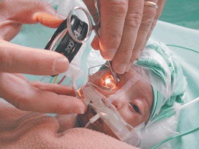 Pediatría Basada en Pruebas: El tratamiento de la retinopatía de la ...