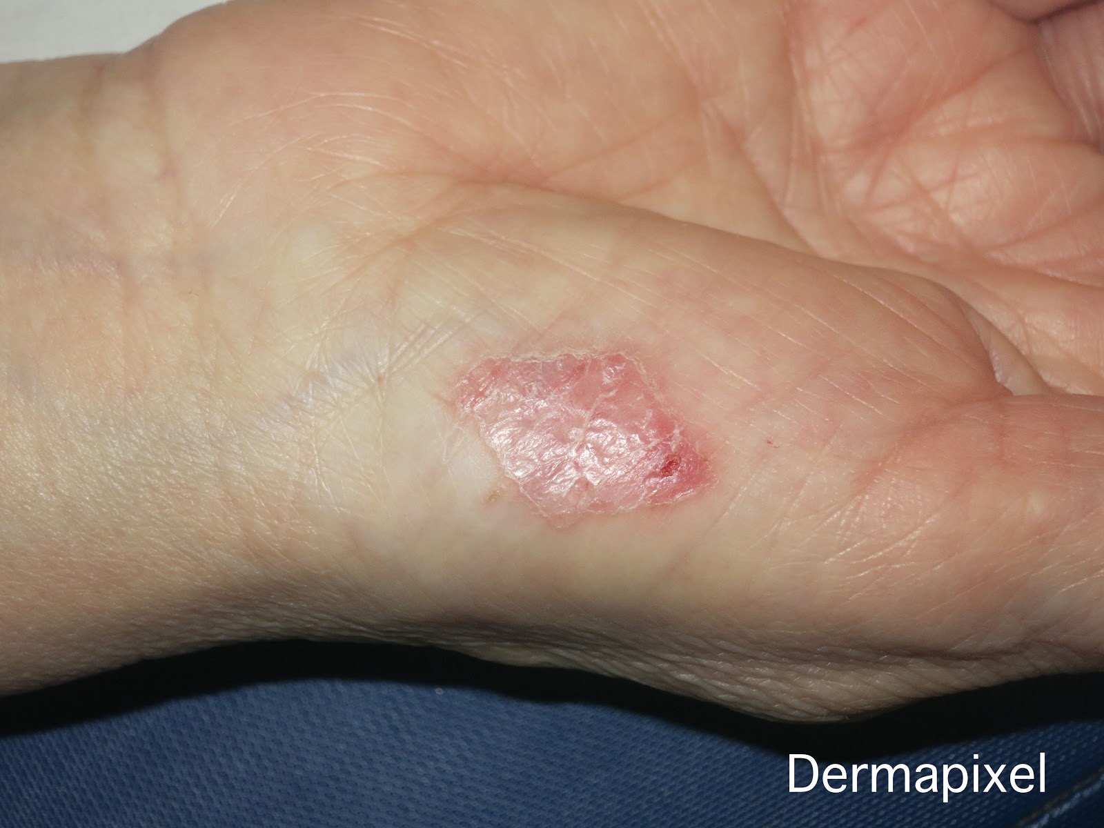 Dermapixel: Un callo un poco extraño