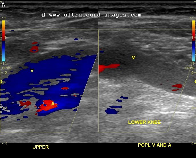 cochinblogs: Ultrasound imaging of popliteal vein thrombosis