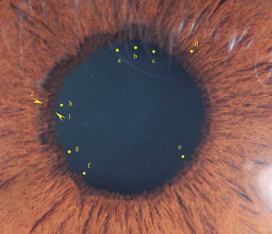 Modern & Multidimensional Iridology: The Inner Pupillary Border ...