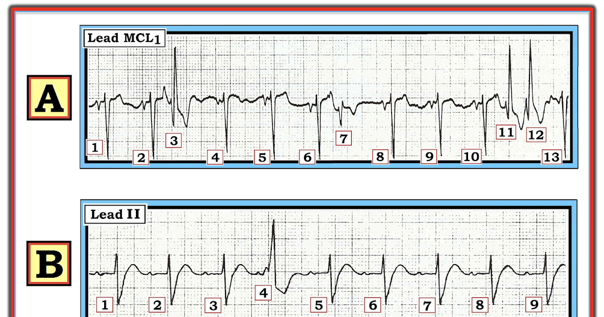 ECG Interpretation: ECG Blog #211 — Why Aberrant Conduction?