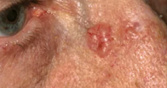 Basaliom entfernen, Ursachen, Symptome, Behandlung, Hausmittel und ...