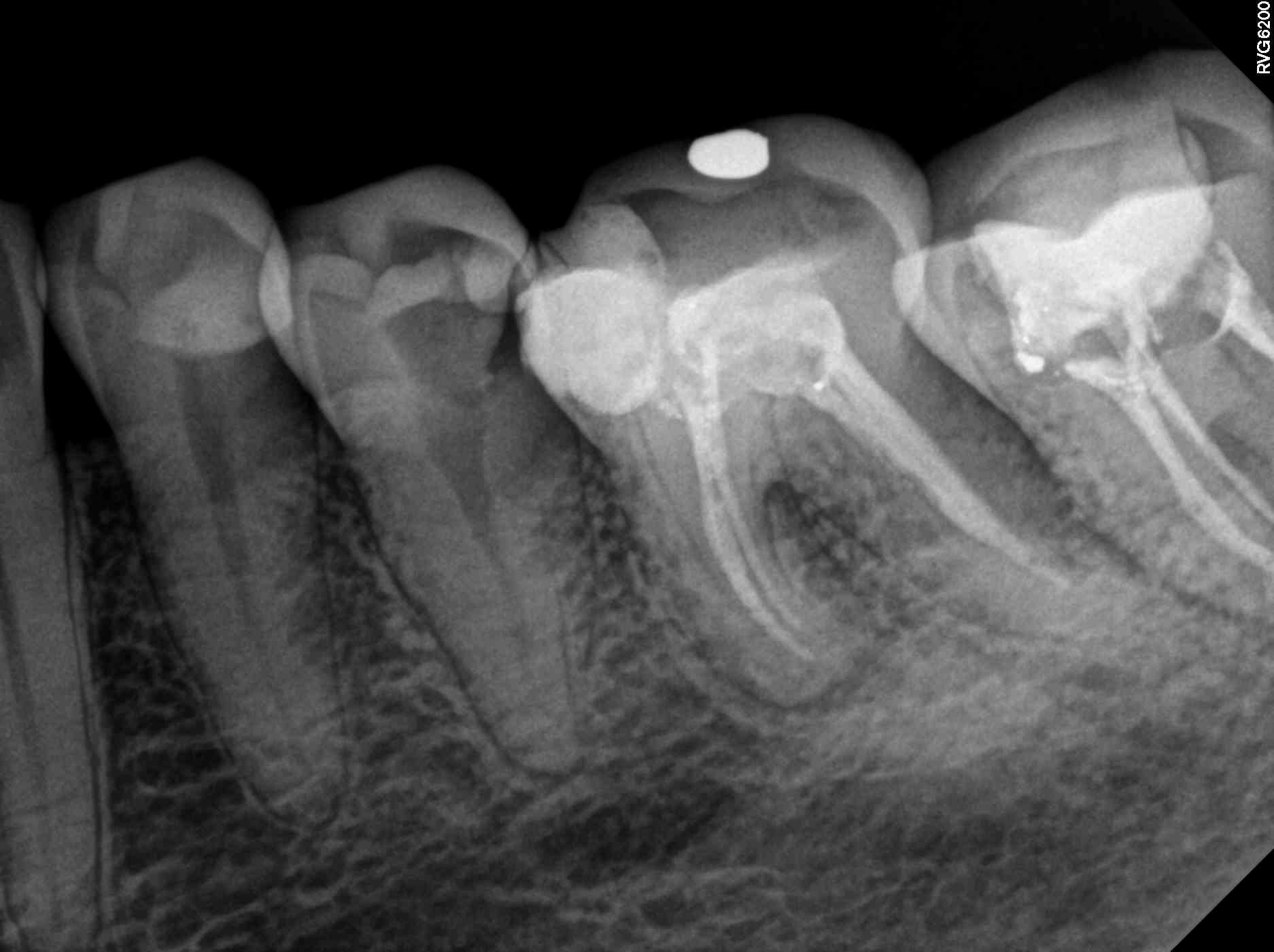 TRATAMIENTO DE CONDUCTOS: Premolares Inferiores