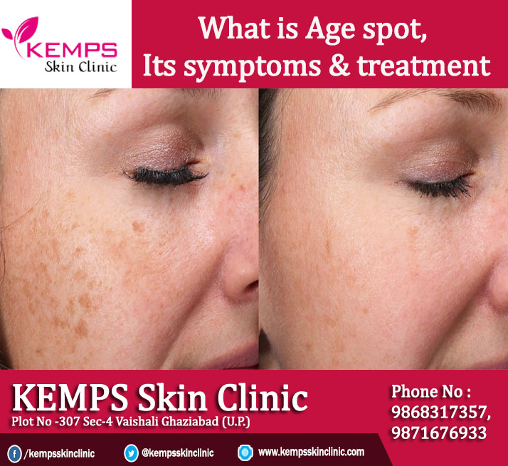 What is Age spot, Its symptoms and treatment | KEMPS Skin Clinic