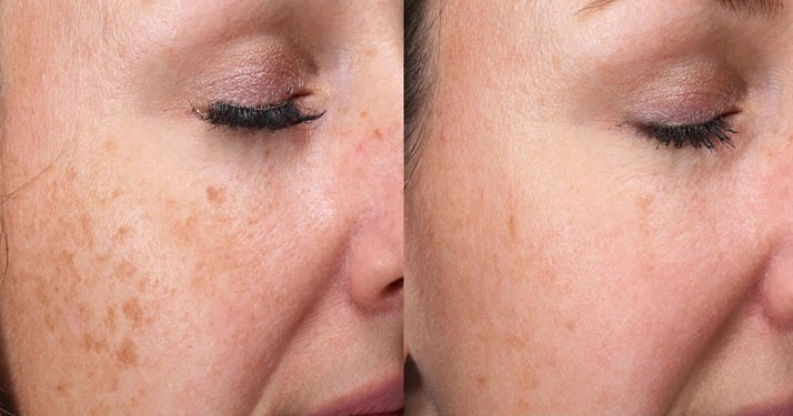 What is Age spot, Its symptoms and treatment | KEMPS Skin Clinic