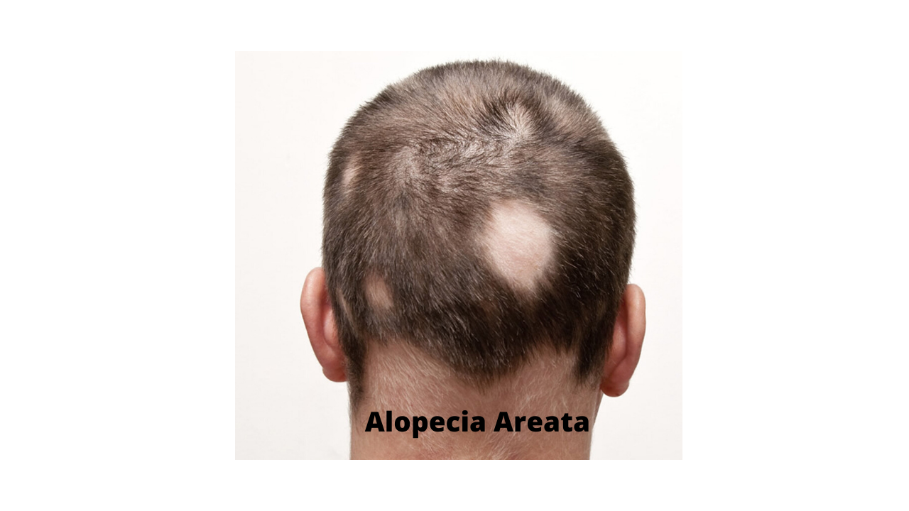Alopecia areata [CAUSES, SYMPTOMS, STAGES & TREATMENT]