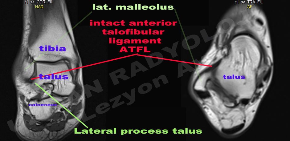 Anterior Talofibular Ligament Mri