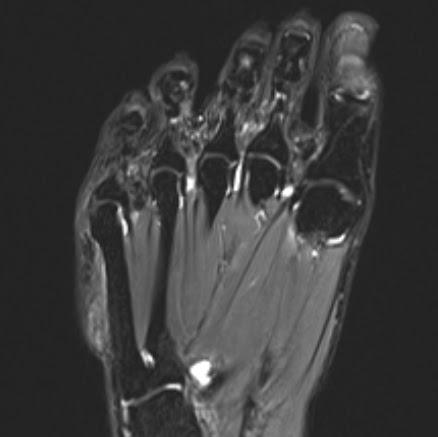 Foot and Ankle Problems By Dr. Richard Blake: Bursitis vs Neuritis ...