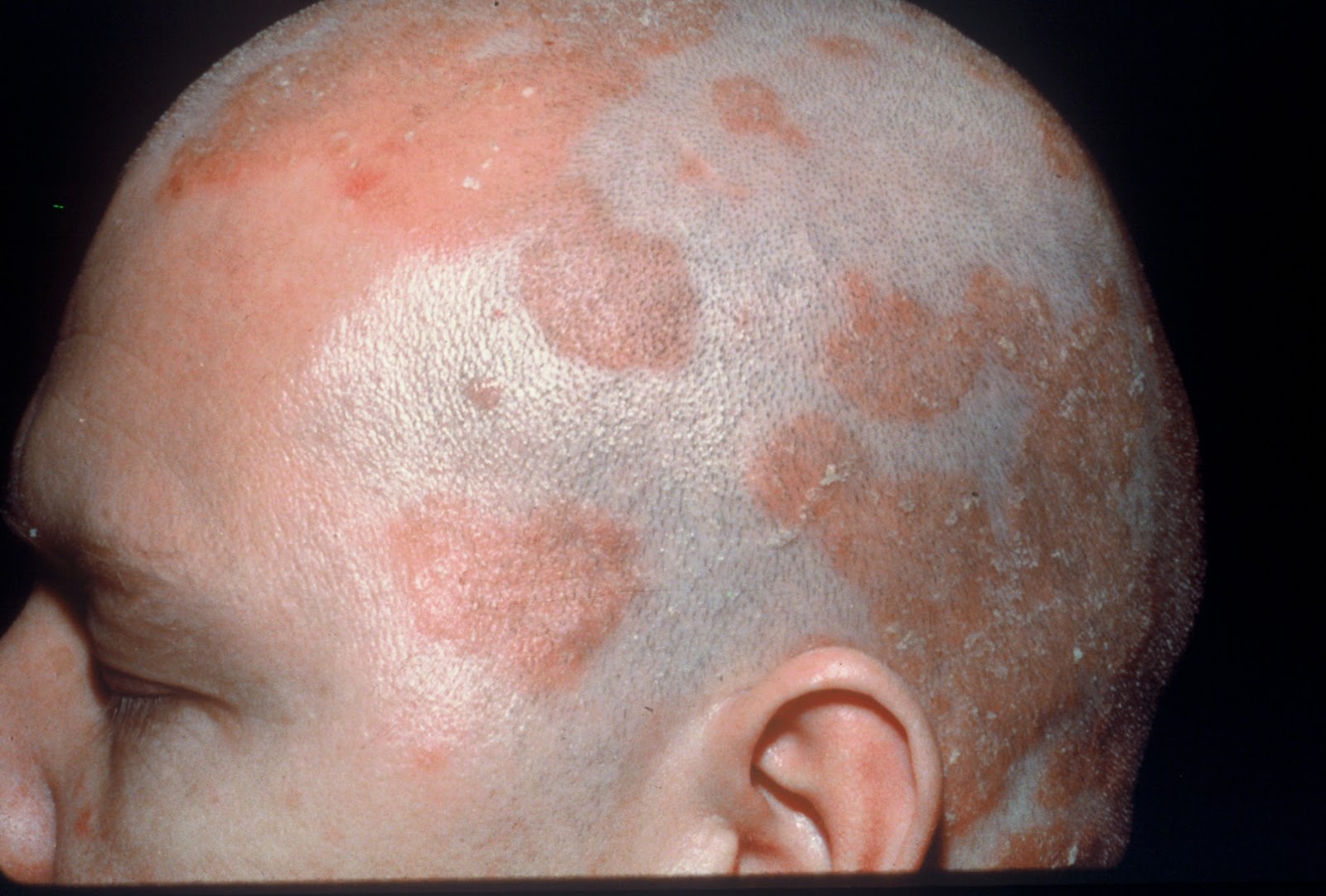 SKIN DISEASE TYPES: Tinea Capitis