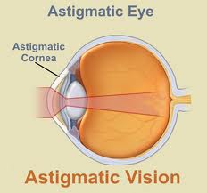 Definition of Astigmatism | Medical Help, Health Tips